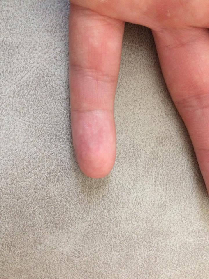 Czy złamałem palec (paliczek dalszy)? - Analiza RTG - Forum Zdrowie - Forum